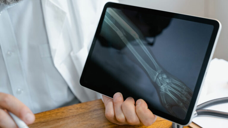 Indemnisation de la victime de paralysie du nerf radial